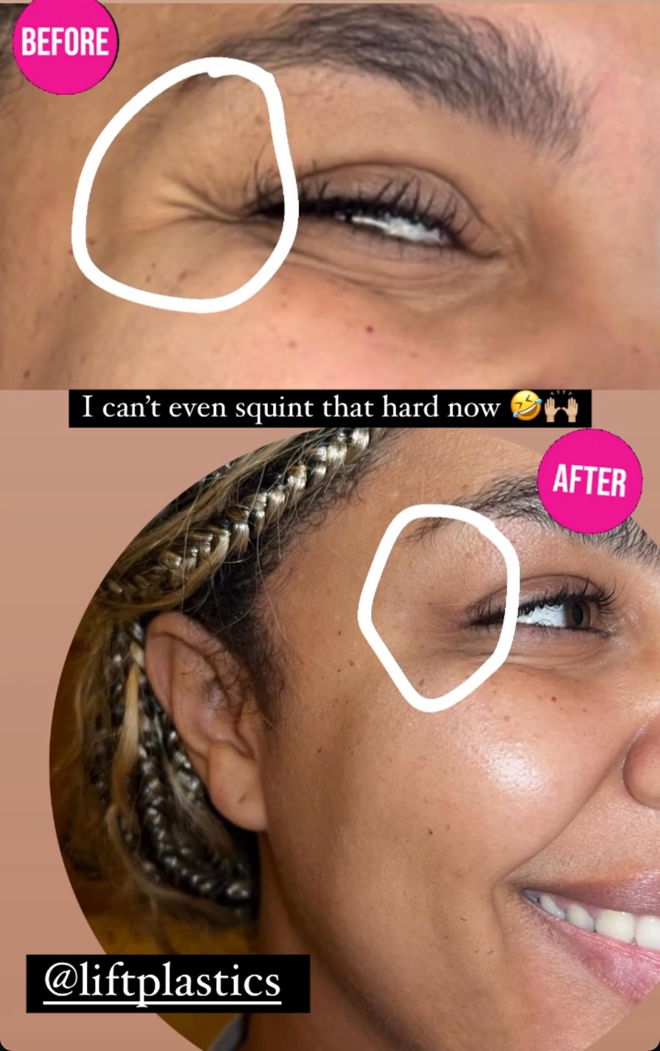 The Botox Journey: Before, After, and Everything inBetween · A Letter ...